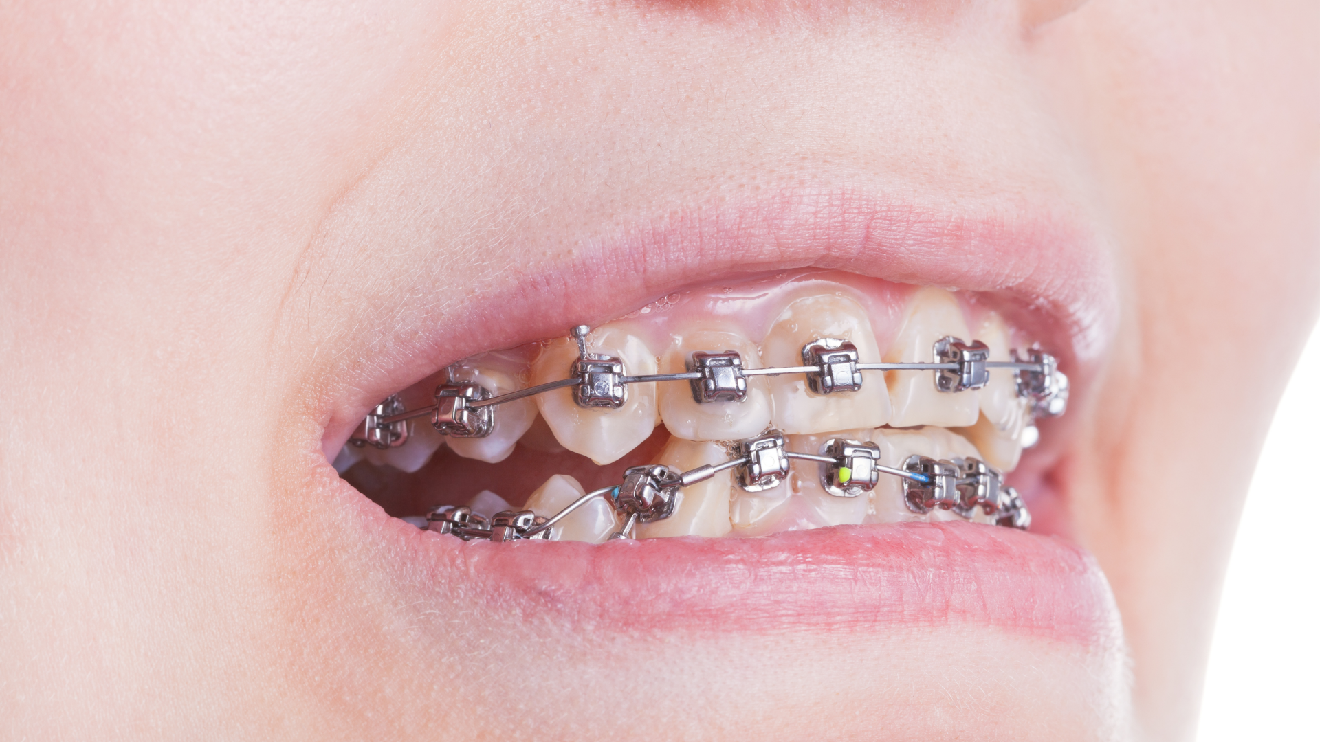 ¿Qué son los brackets Damon? - Clínica San Magno